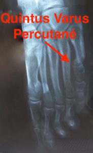 Pied : Déformations des Orteils / Métatarsalgies / Morton - Dr Fabien ...